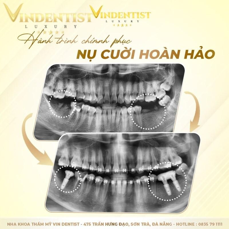 Luu-y-khi-trong-rang-implant.1 - Nha Khoa VIN Dentist