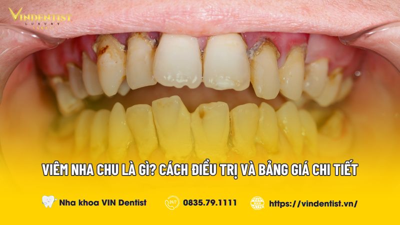 Viêm Nha Chu Là Gì? Cách Điều Trị Và Bảng Giá Chi tiết